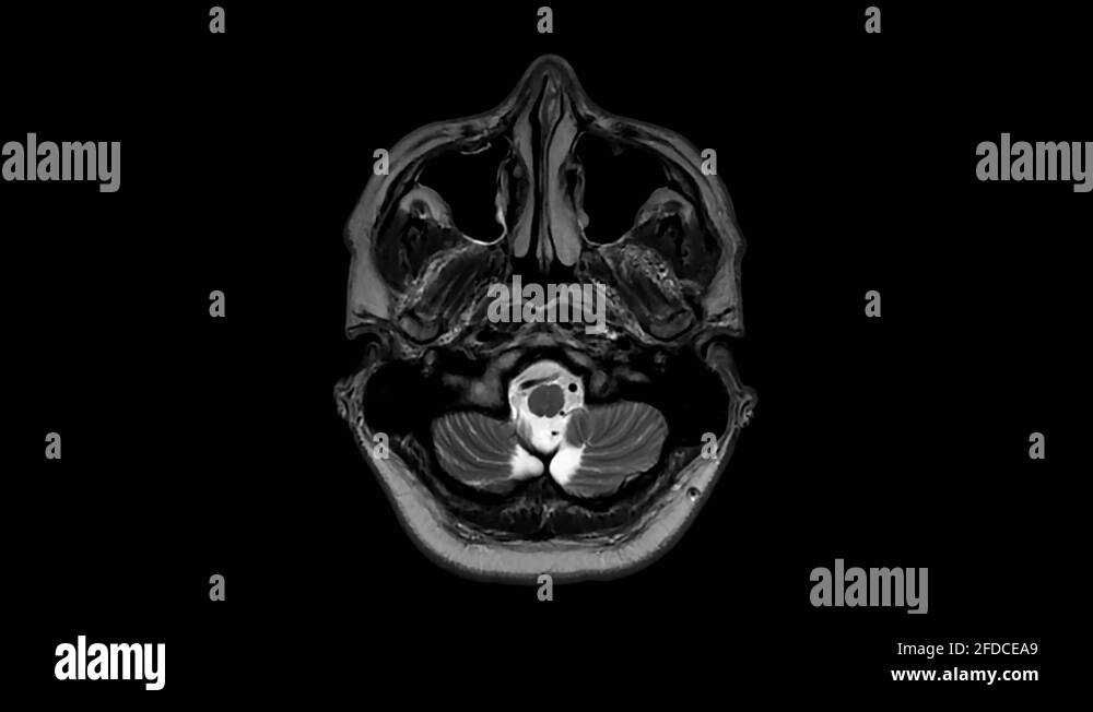 Pathologie,Magnetic Resonance Imaging (MRI), Human brain real MRI scan ...