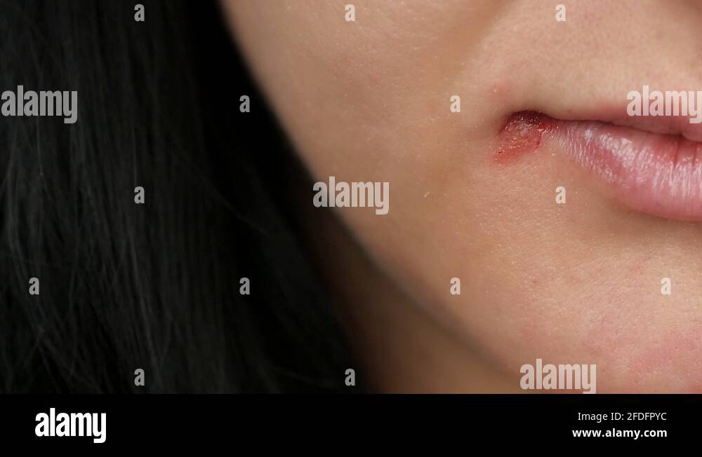 Face scab Stock Videos & Footage - HD and 4K Video Clips - Alamy