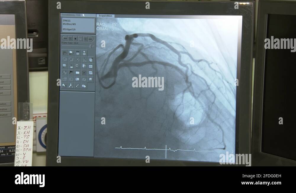 screen of equipment for coronary angiography, moving heart and blood ...