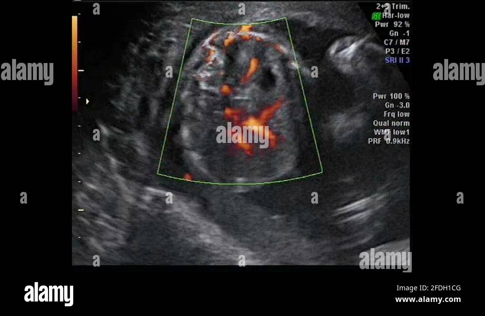 Implantation of the embryo Stock Videos & Footage - HD and 4K Video ...