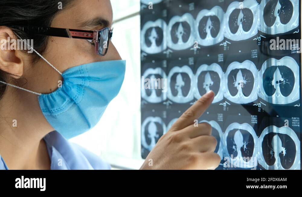 Chest x ray examination diagnosis pulmonary Stock Videos & Footage - HD ...