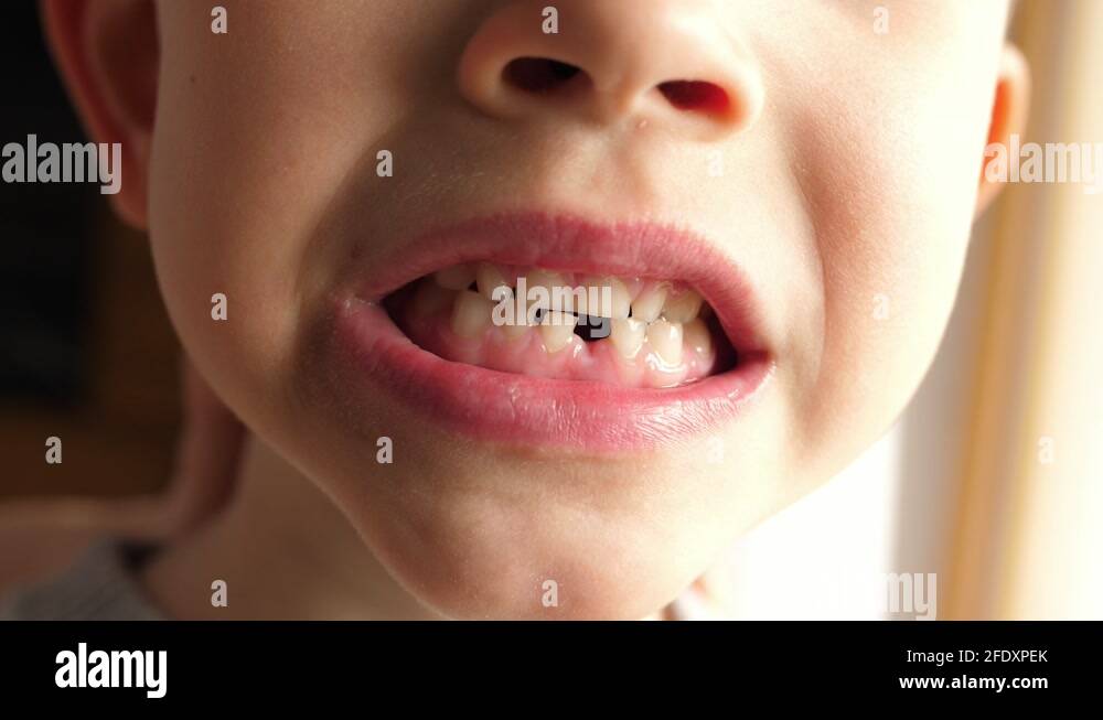 Falling out of tooth Stock Videos & Footage - HD and 4K Video Clips - Alamy