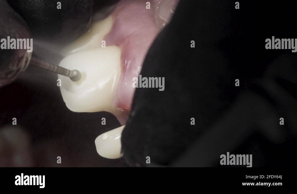 Steel tooth Stock Videos & Footage - HD and 4K Video Clips - Alamy