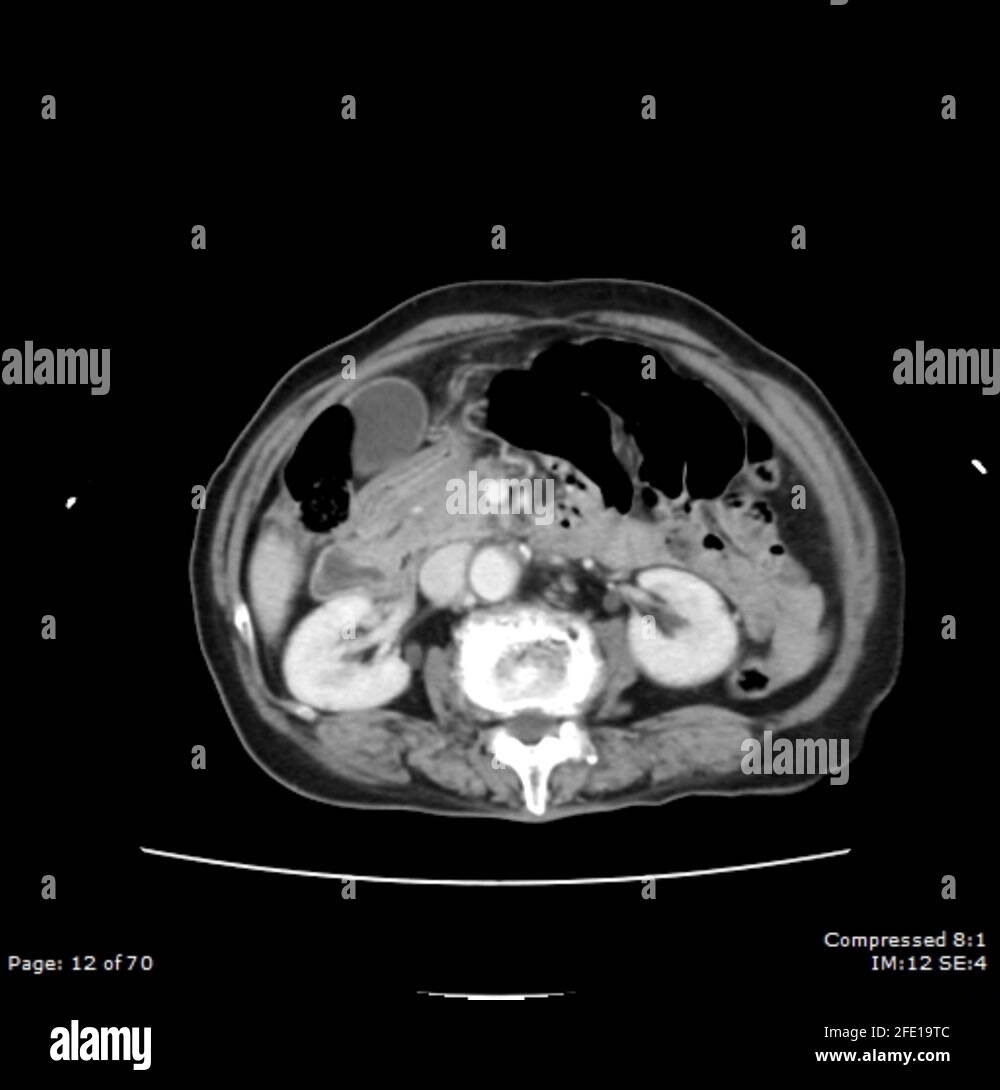 CT scan Axial view with contrast for diagnosis Abdominal aortic ...