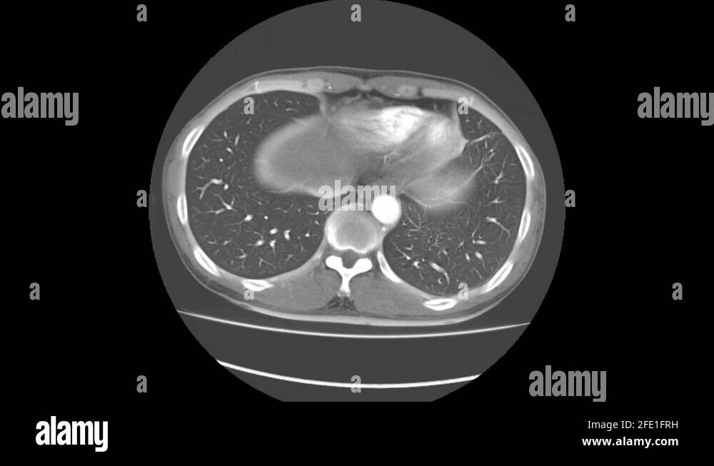 Abdominal anatomy ribs Stock Videos & Footage - HD and 4K Video Clips ...