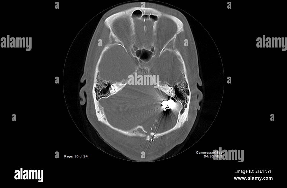 CT scan axial view with bullet fragmentation in brain male 20 year old ...