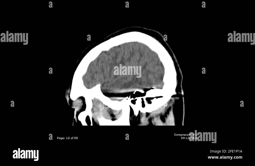 CT scan sagittal view with bullet fragmentation in brain male 20 year ...
