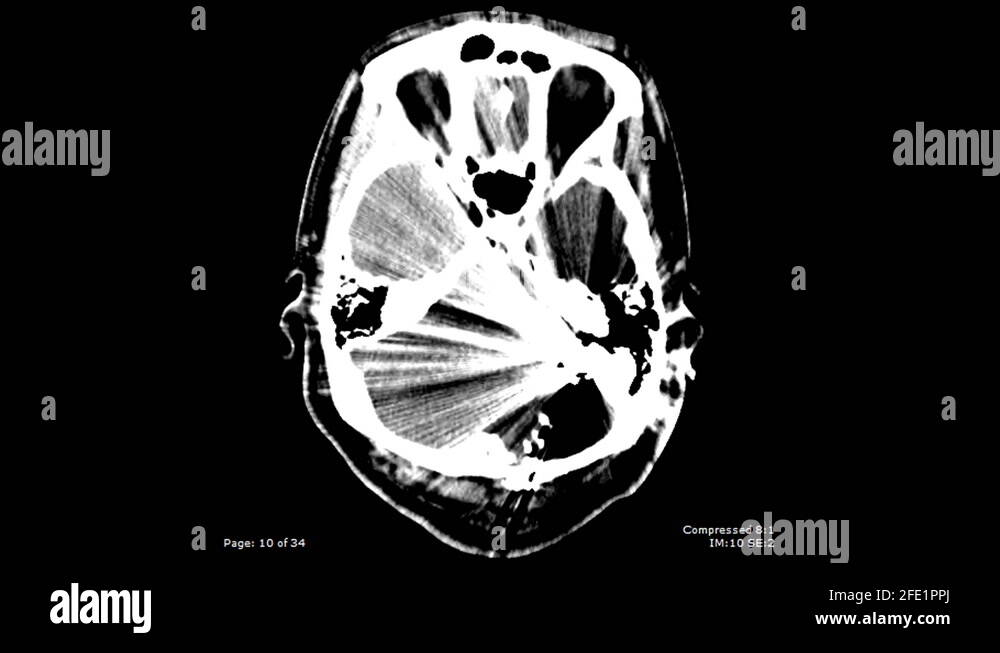 CT scan axial view with bullet fragmentation in brain male 20 year old ...