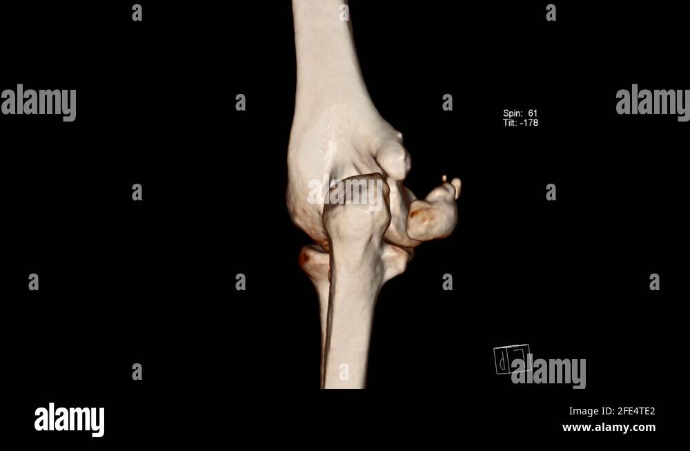 Computed Tomography Volume Rendering examination of the Elbow joint ...