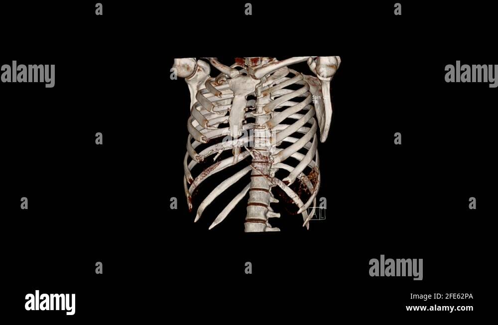 3d thoracic cage Stock Videos & Footage - HD and 4K Video Clips - Alamy