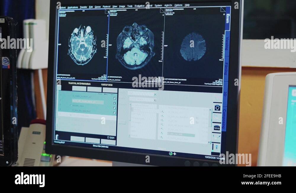 Mri image of head showing brain Stock Videos & Footage - HD and 4K ...