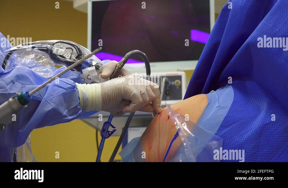 Shoulder arthroscopy Stock Videos & Footage - HD and 4K Video Clips - Alamy