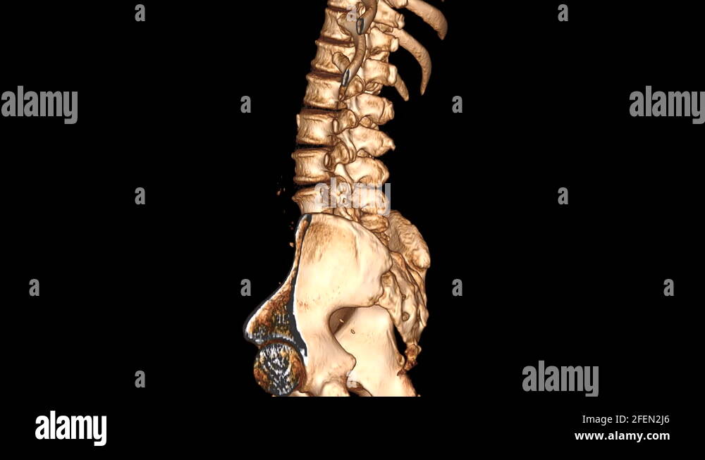 3d reconstruction of spine Stock Videos & Footage - HD and 4K Video ...