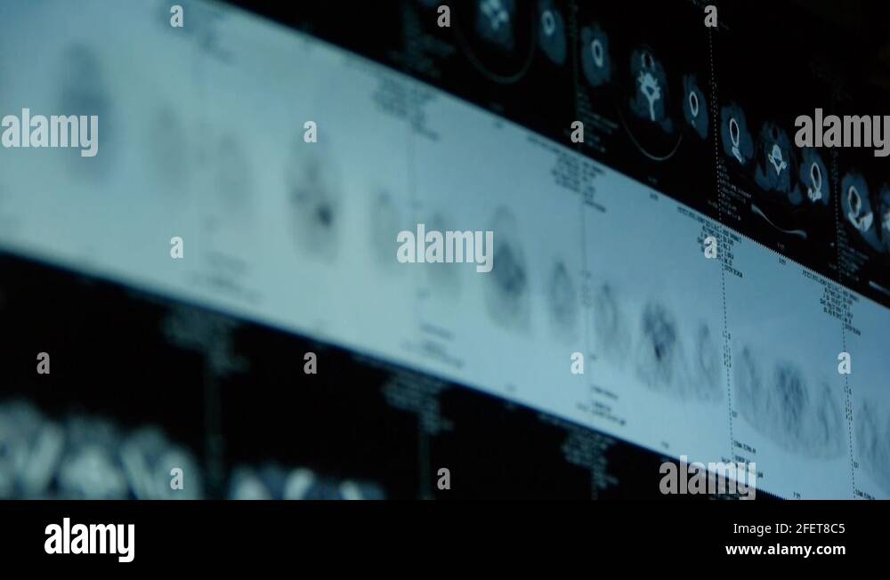 human subclavian pet-ct scan,lymph nodes X-ray,Cancer metastasis Stock ...