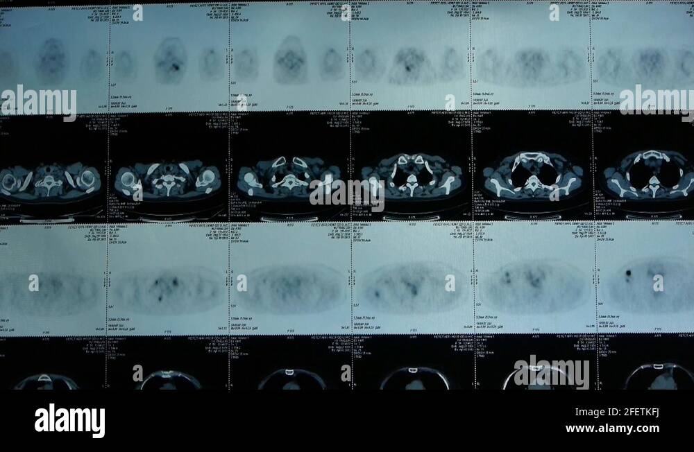 human subclavian pet-ct scan,lymph nodes X-ray,Cancer metastasis Stock ...