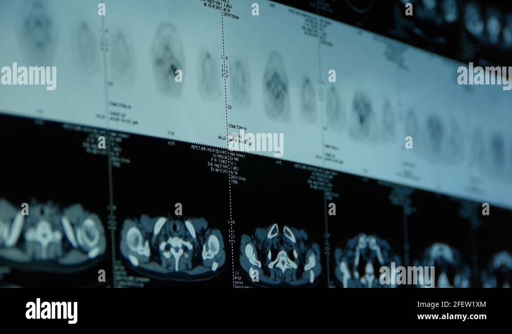 human subclavian pet-ct scan,lymph nodes X-ray,Cancer metastasis Stock ...