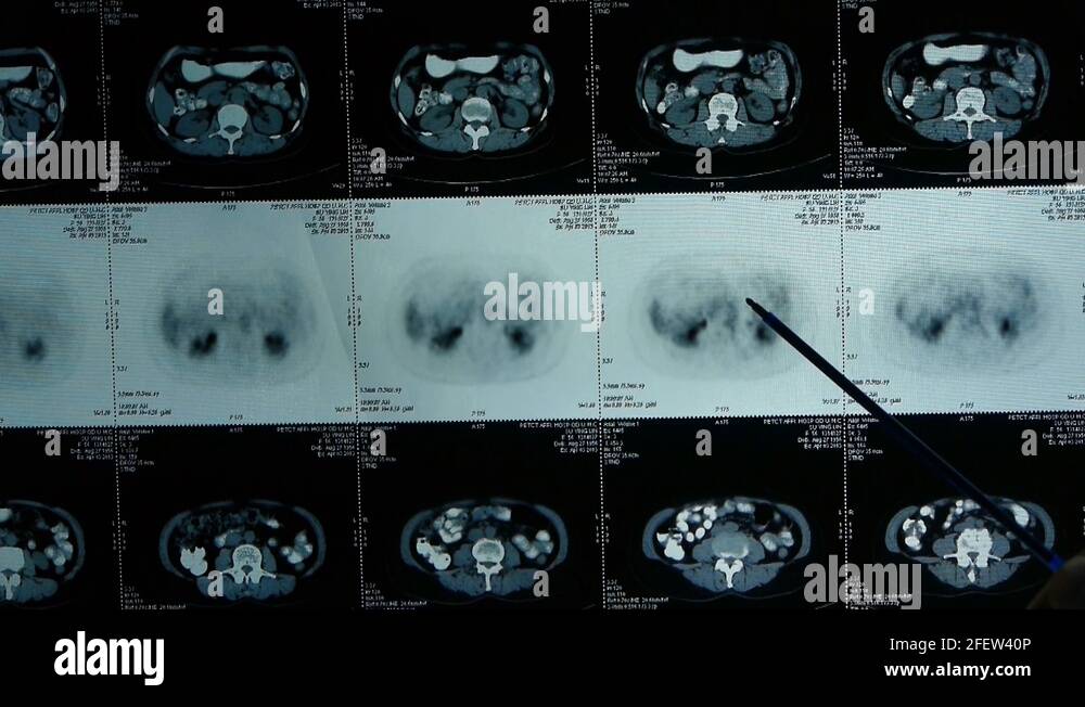 doctor study clavicle pet-ct scan,lymph nodes X-ray,Cancer metastasis ...