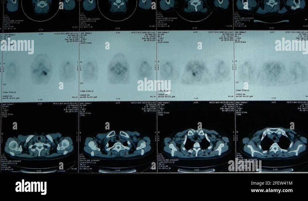 human subclavian pet-ct scan,lymph nodes X-ray,Cancer metastasis Stock ...