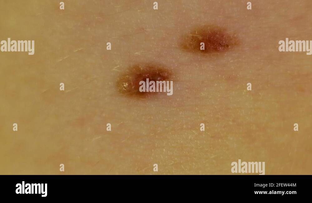 Two skin moles next each other Stock Video Footage - Alamy