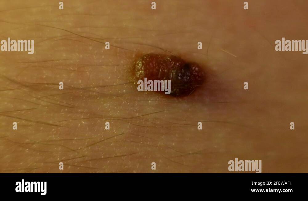 Skin mole Stock Videos & Footage - HD and 4K Video Clips - Alamy