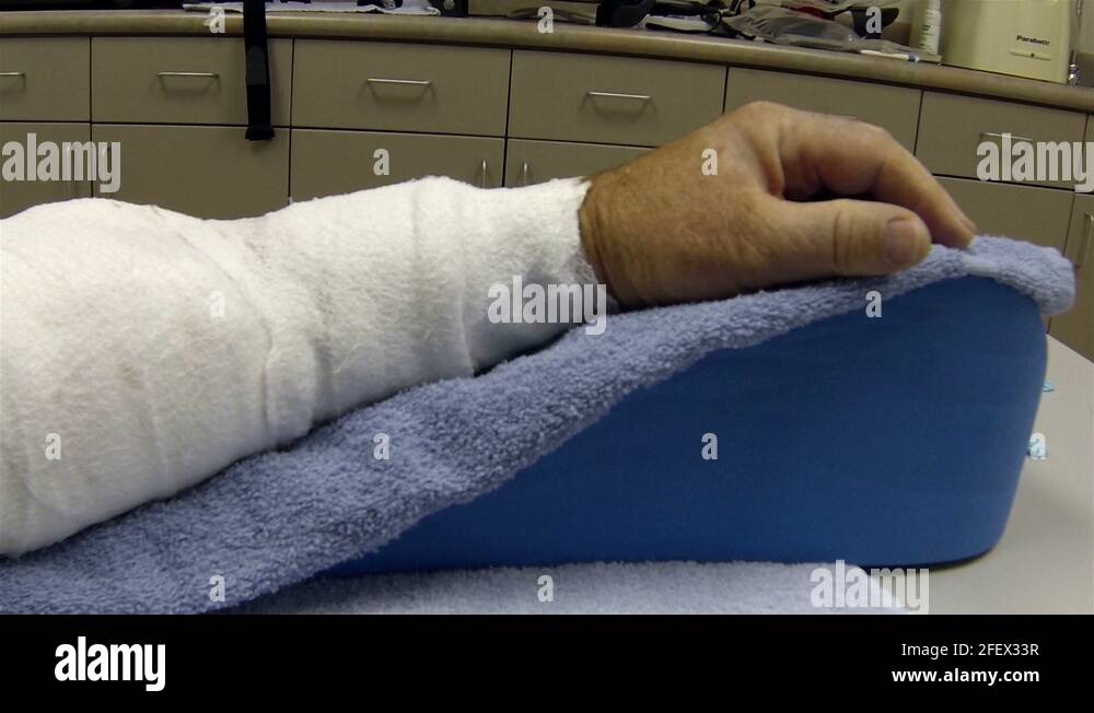 Patient's arm in bandage after major surgery HD 005 Stock Video Footage ...