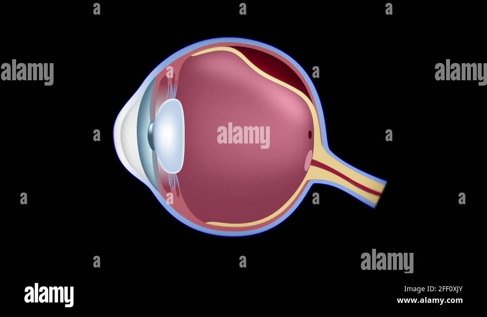 Diagram retinal detachment Stock Videos & Footage - HD and 4K Video ...