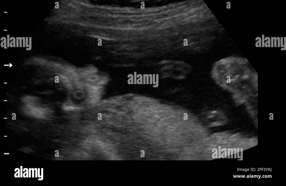 Baby embryo imaging Stock Videos & Footage - HD and 4K Video Clips - Alamy