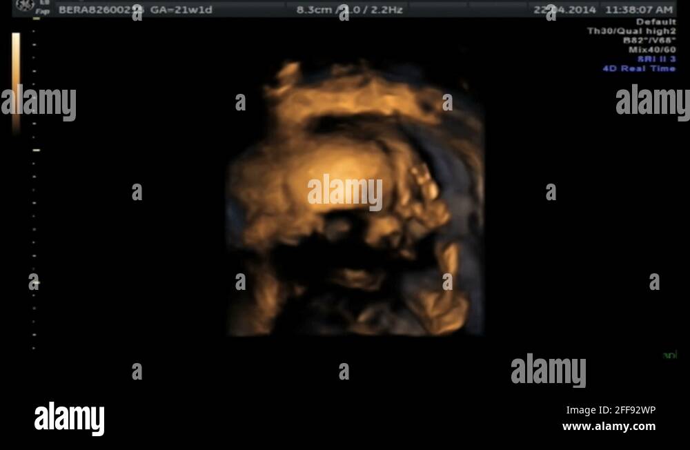 Foetus ultrasound Stock Videos & Footage - HD and 4K Video Clips - Alamy