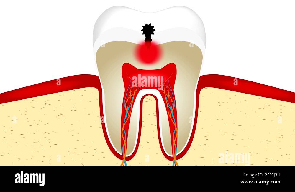 Rotting tooth Stock Videos & Footage - HD and 4K Video Clips - Alamy