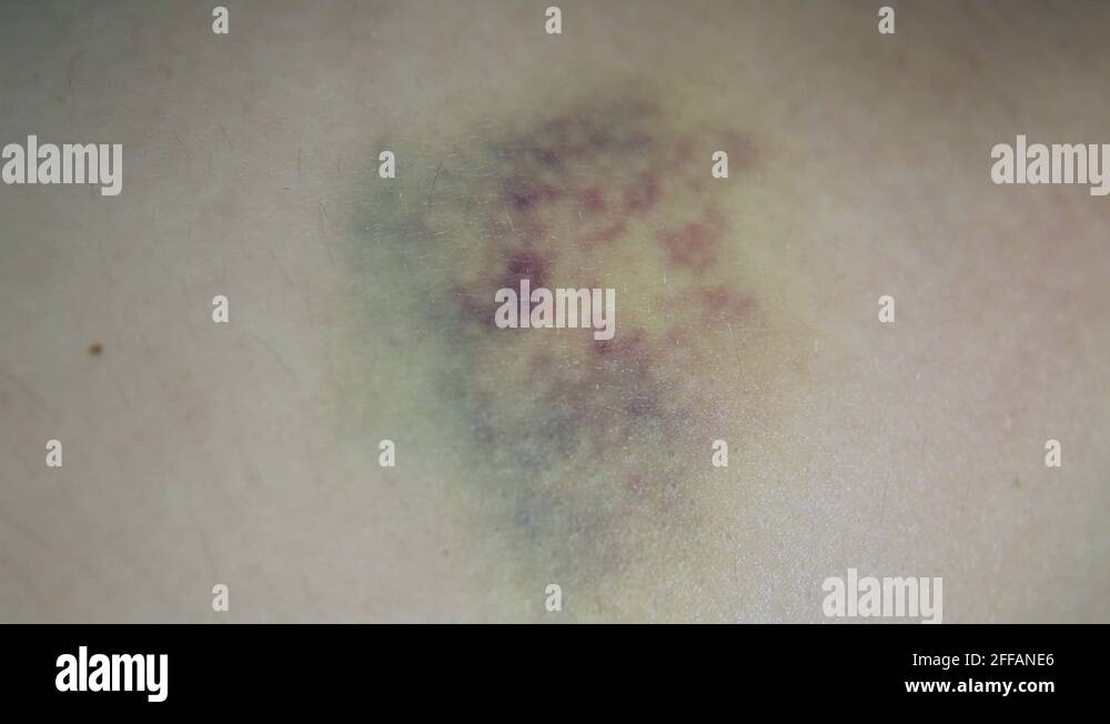 Muscle damage Stock Videos & Footage - HD and 4K Video Clips - Alamy