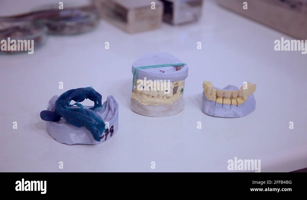 Dental implant, dentist hands holding a jaw, plaster cast, jaw cast ...