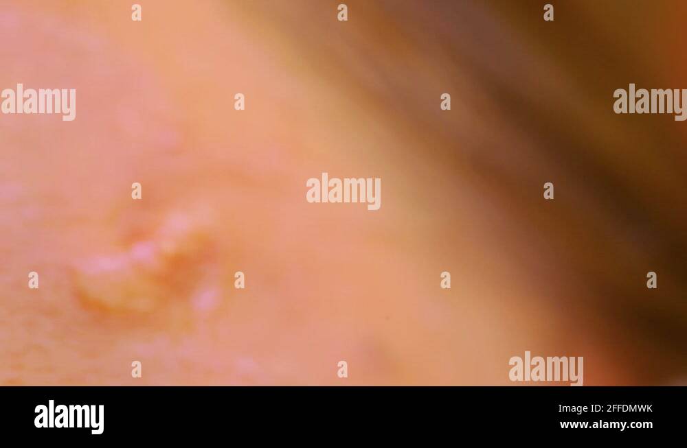 Papules and pustules Stock Videos & Footage - HD and 4K Video Clips - Alamy