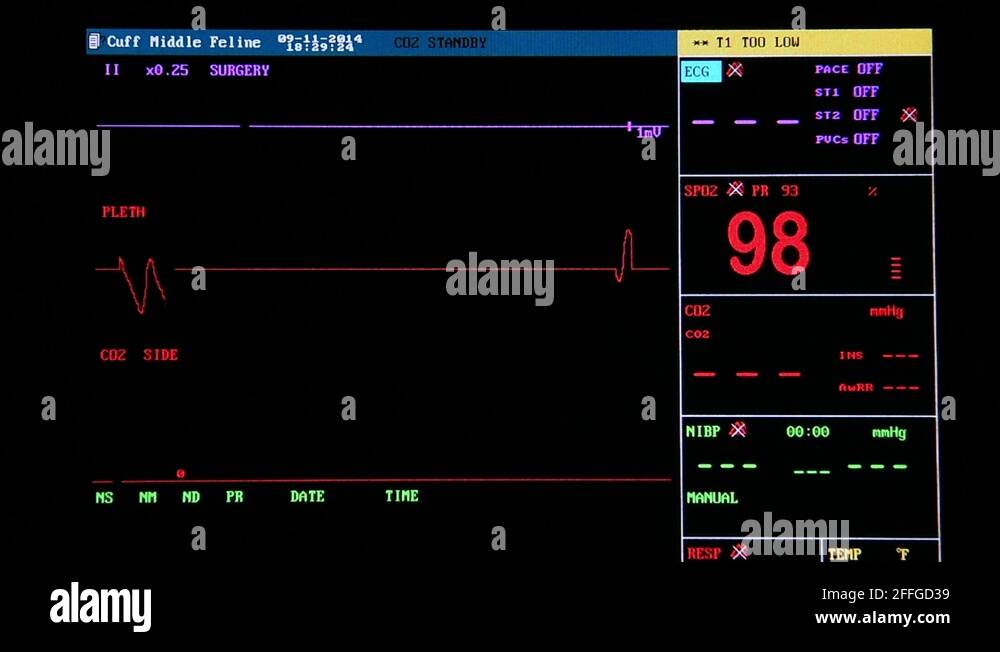 Ecg monitor patient's condition in operating room Stock Video Footage ...