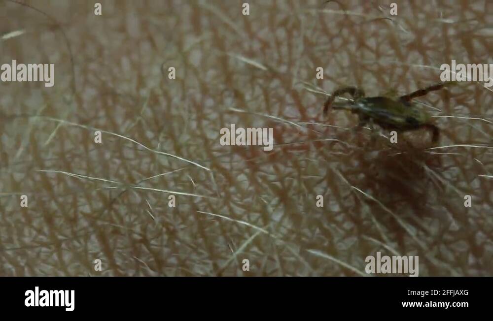 Parasitiformes Stock Videos & Footage - HD and 4K Video Clips - Alamy