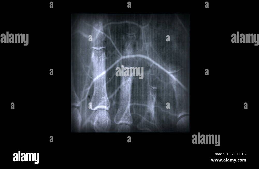 4k Human rib finger bone scan,tech medical X-ray,medical research,body ...