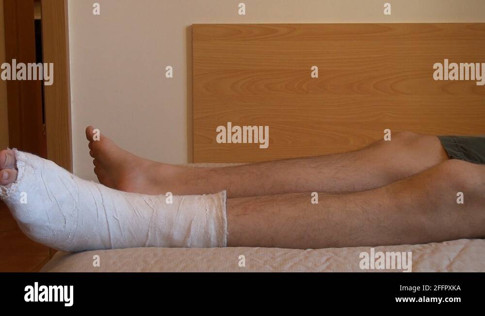 Man leg cast Stock Videos & Footage - HD and 4K Video Clips - Alamy