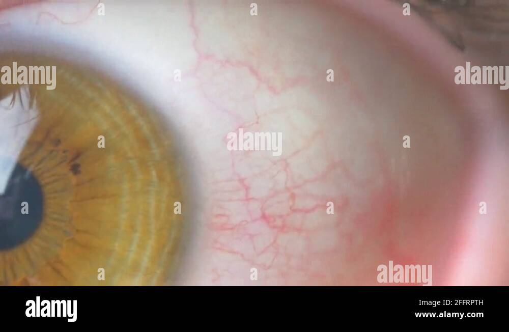 Retinal veins Stock Videos & Footage - HD and 4K Video Clips - Alamy