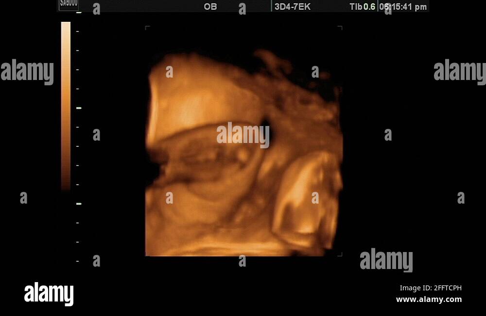 Fetus umbilical cord placenta Stock Videos & Footage - HD and 4K Video ...