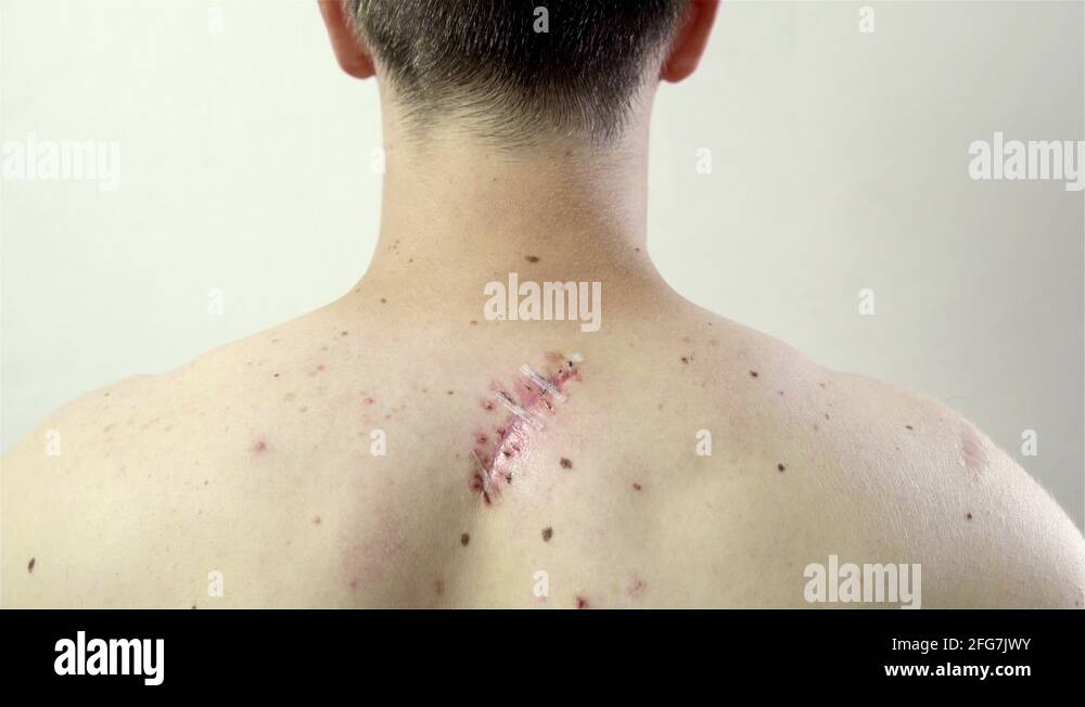Wound scar on male back with tape over 4K Stock Video Footage - Alamy