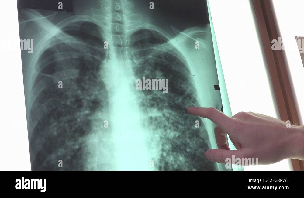 Human chest x ray Stock Videos & Footage - HD and 4K Video Clips - Alamy