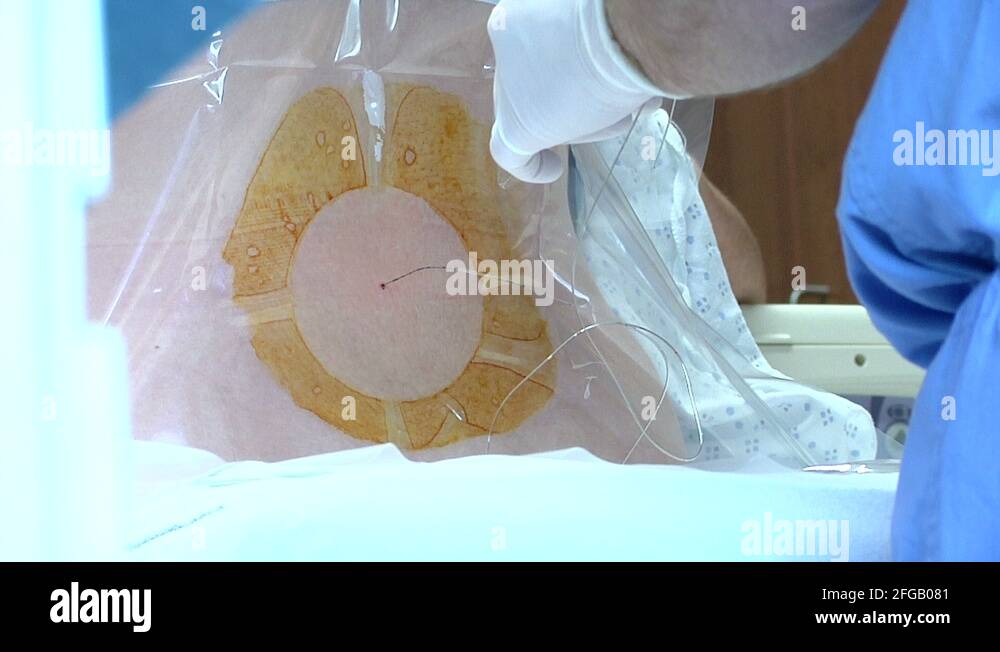 Woman Getting Epidural Stock Video Footage - Alamy