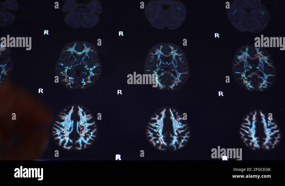 Brain mri scan computer screen Stock Videos & Footage - HD and 4K Video ...