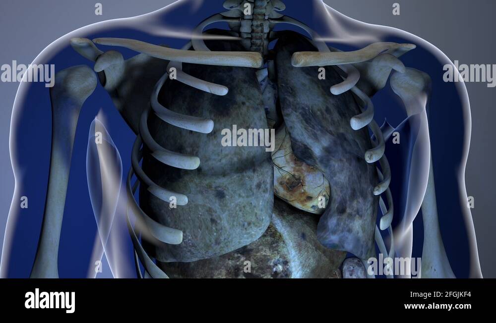 Sick Internal Organs in a Transparent Human Body Anatomical 3D ...