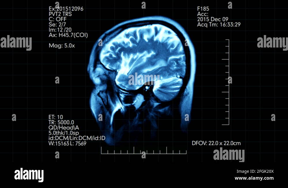 MRI brain scan profile animation with medical data Stock Video Footage ...