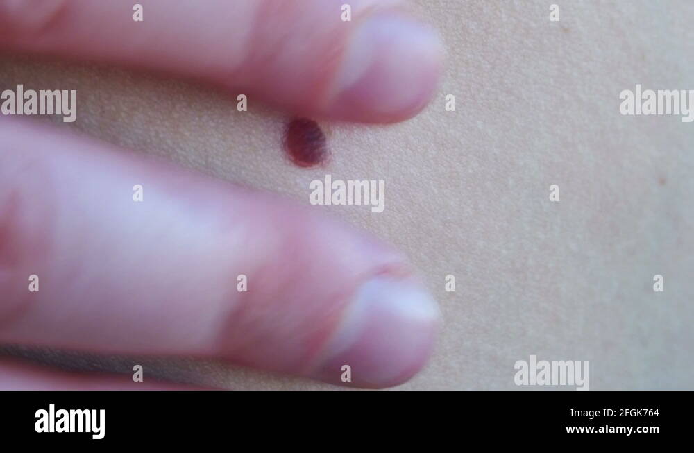 Disease of the skin, color deprive, fungus on the skin Stock Video ...