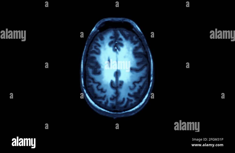 MRI of human Brain - particles form Stock Video Footage - Alamy