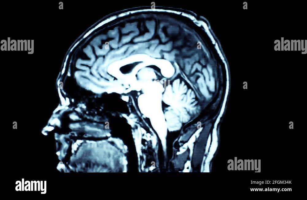 MRI of human Brain - particles form Stock Video Footage - Alamy