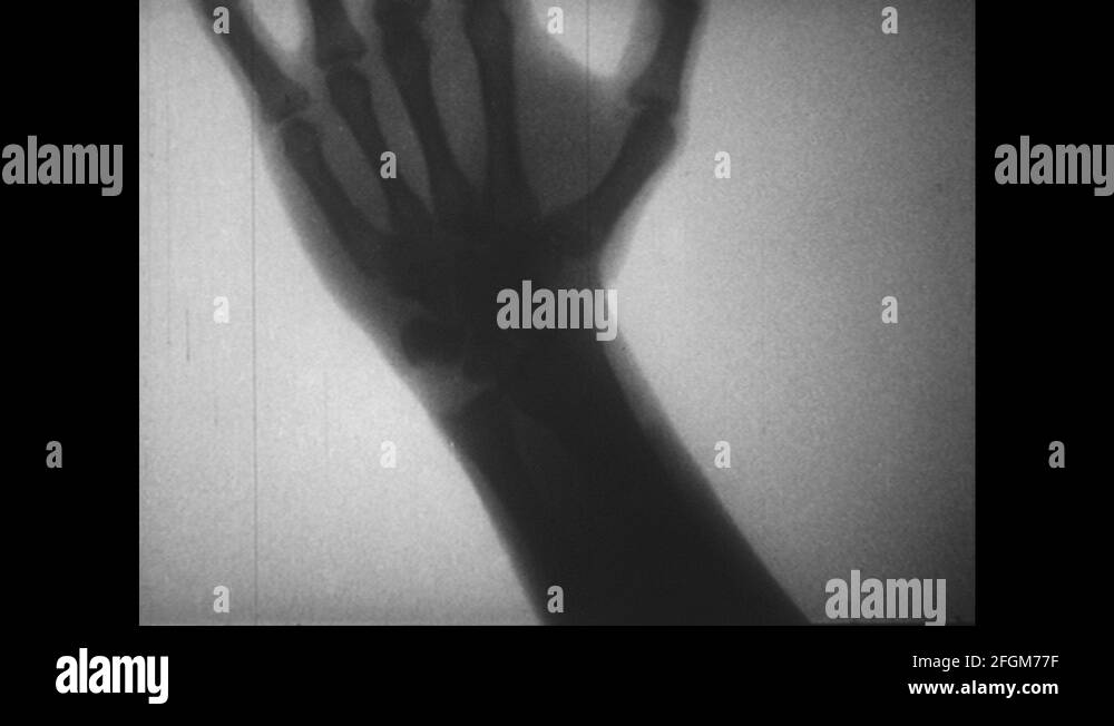 X ray of the forearm bones Stock Videos & Footage - HD and 4K Video ...