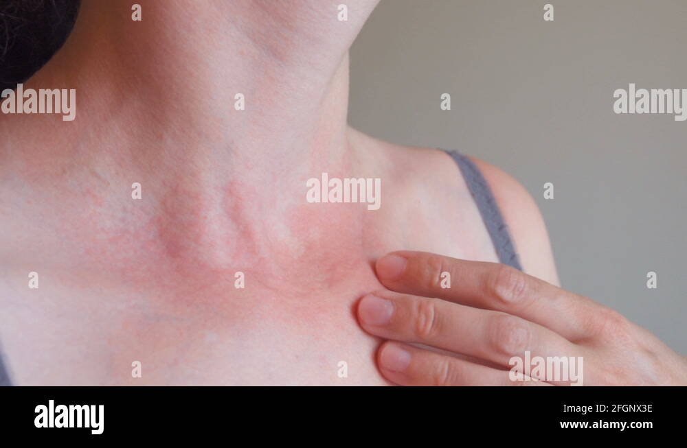 Woman scratch the itch with hand, Neck. Red spots on the neck ...