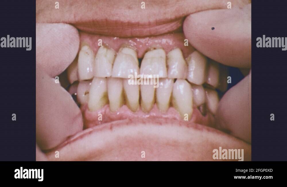 Missing two front teeth Stock Videos & Footage - HD and 4K Video Clips ...